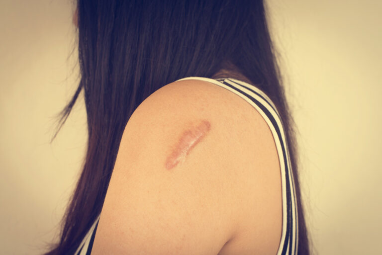 How to Combat Scar Tissue – Midwest Pain Solutions