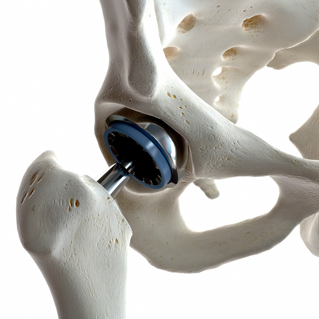 Alternatives to Joint Replacement – Midwest Pain Solutions